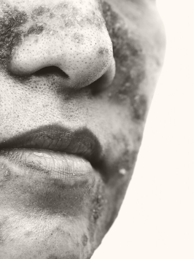 Pipeline - Arcutis Biotherapeutics