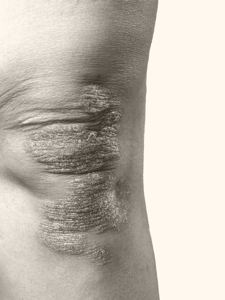 Arcutis Cares Patient Assistance - Arcutis Biotherapeutics