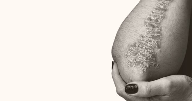 Arcutis Biotherapeutics - Medical dermatology innovation