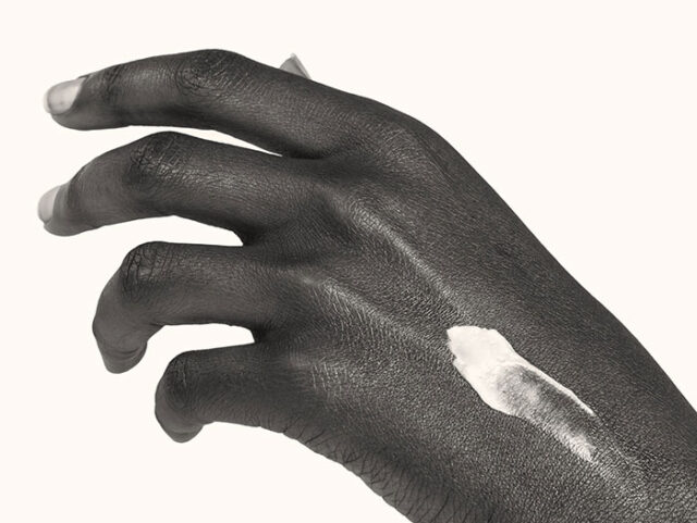 Arcutis Biotherapeutics - Medical dermatology innovation