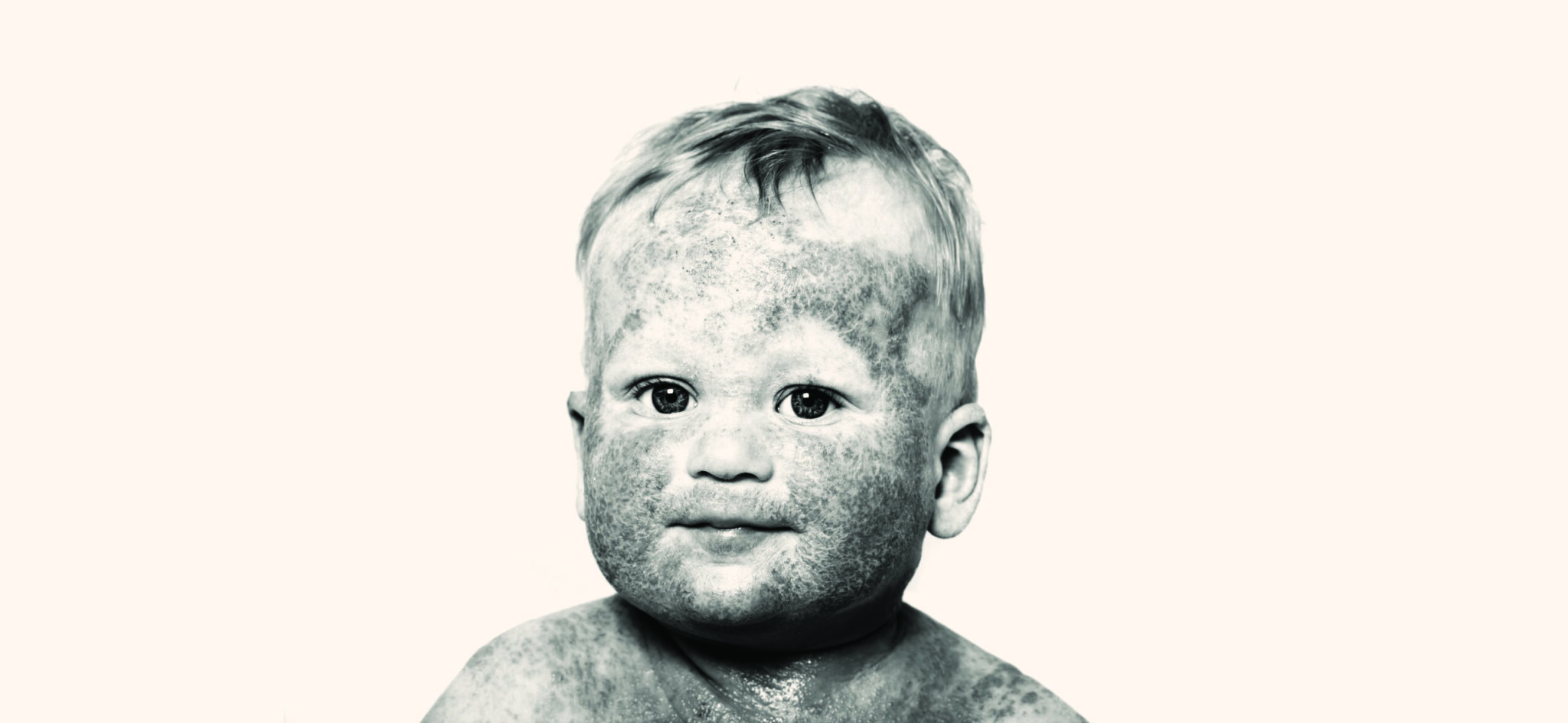 Topical Roflumilast Cream - Arcutis Biotherapeutics