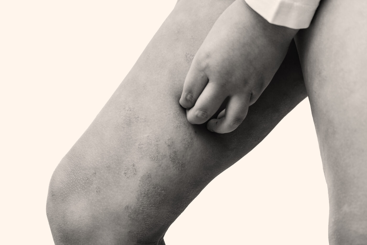 Topical Roflumilast Cream - Arcutis Biotherapeutics